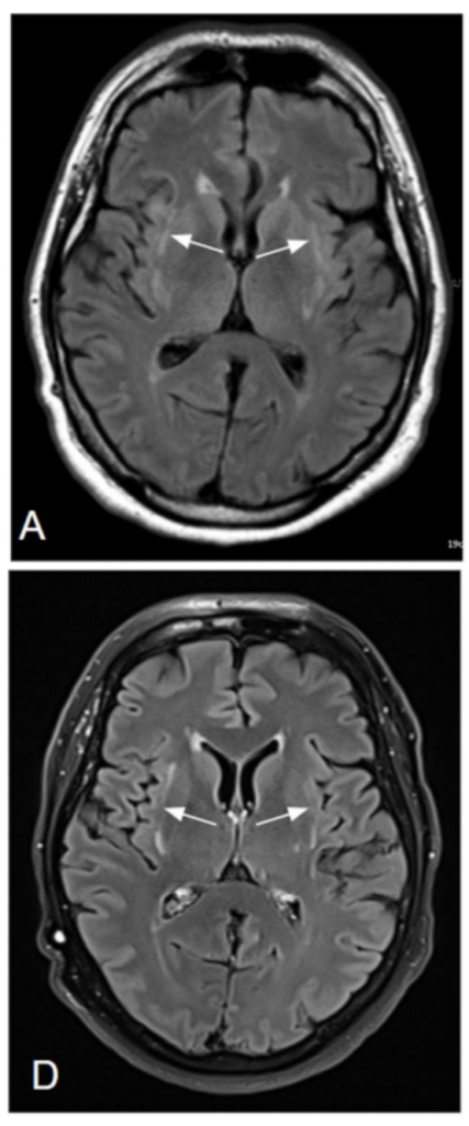 Autoimmune Encephalitis/Epilepsy in COVID-19 Case – Melamed Lab