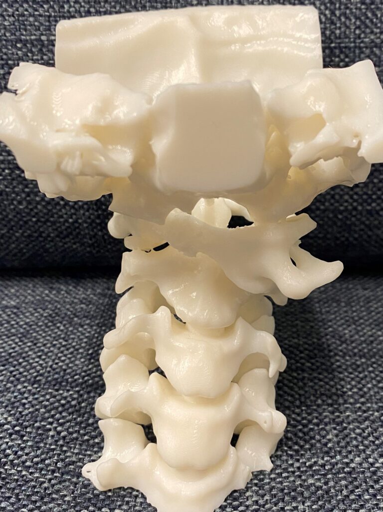 3D Printing to Aid Neurosurgery Planning